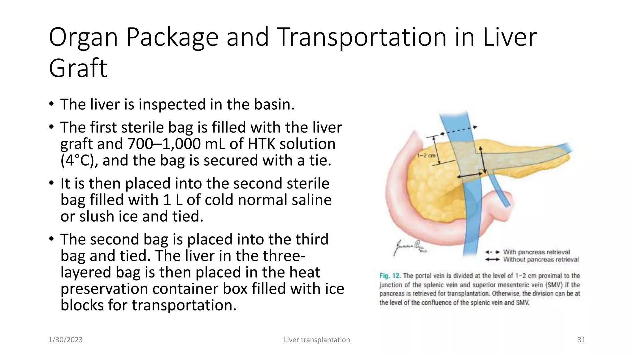 Principles of LIVER TRANSPLANTATION.pptx