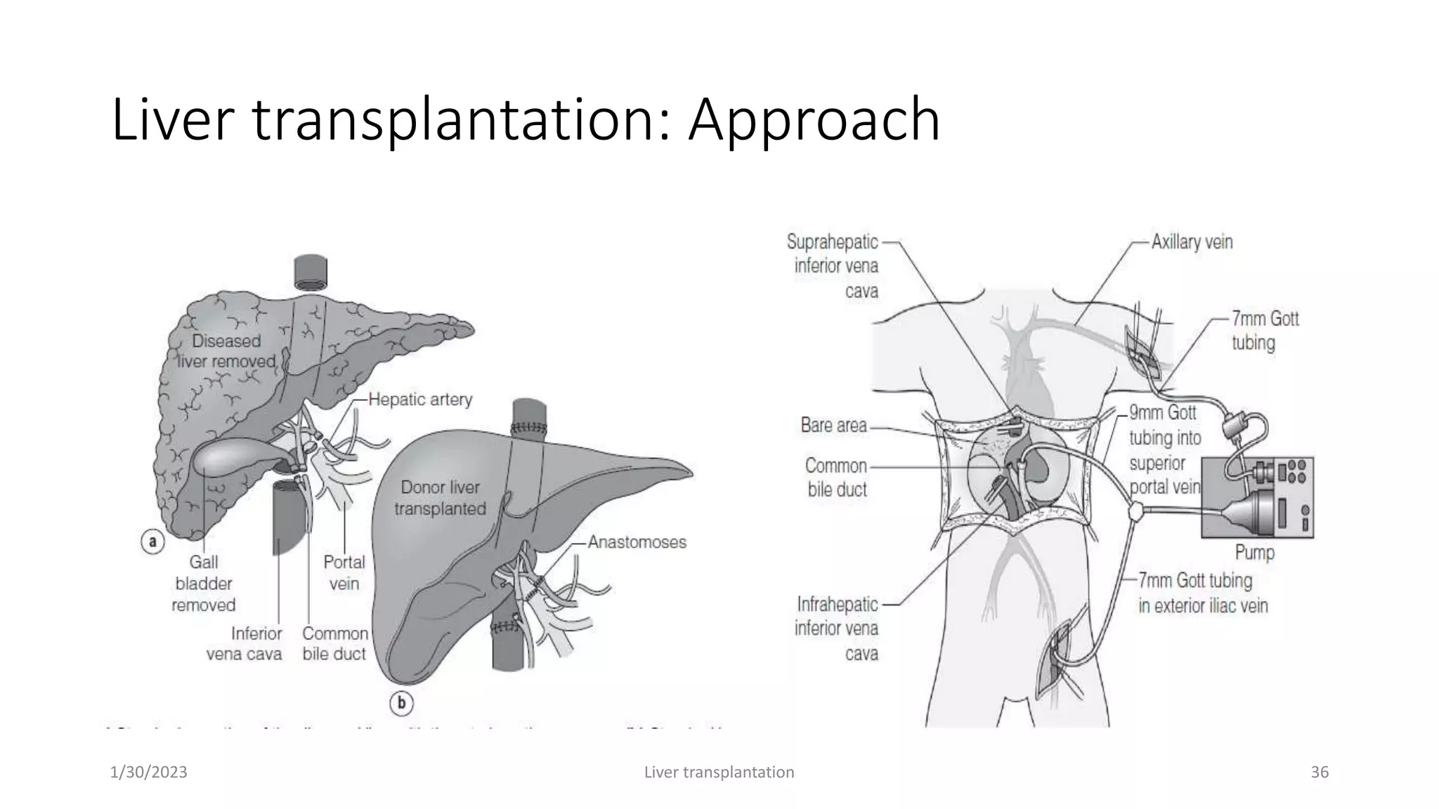 Principles of LIVER TRANSPLANTATION.pptx