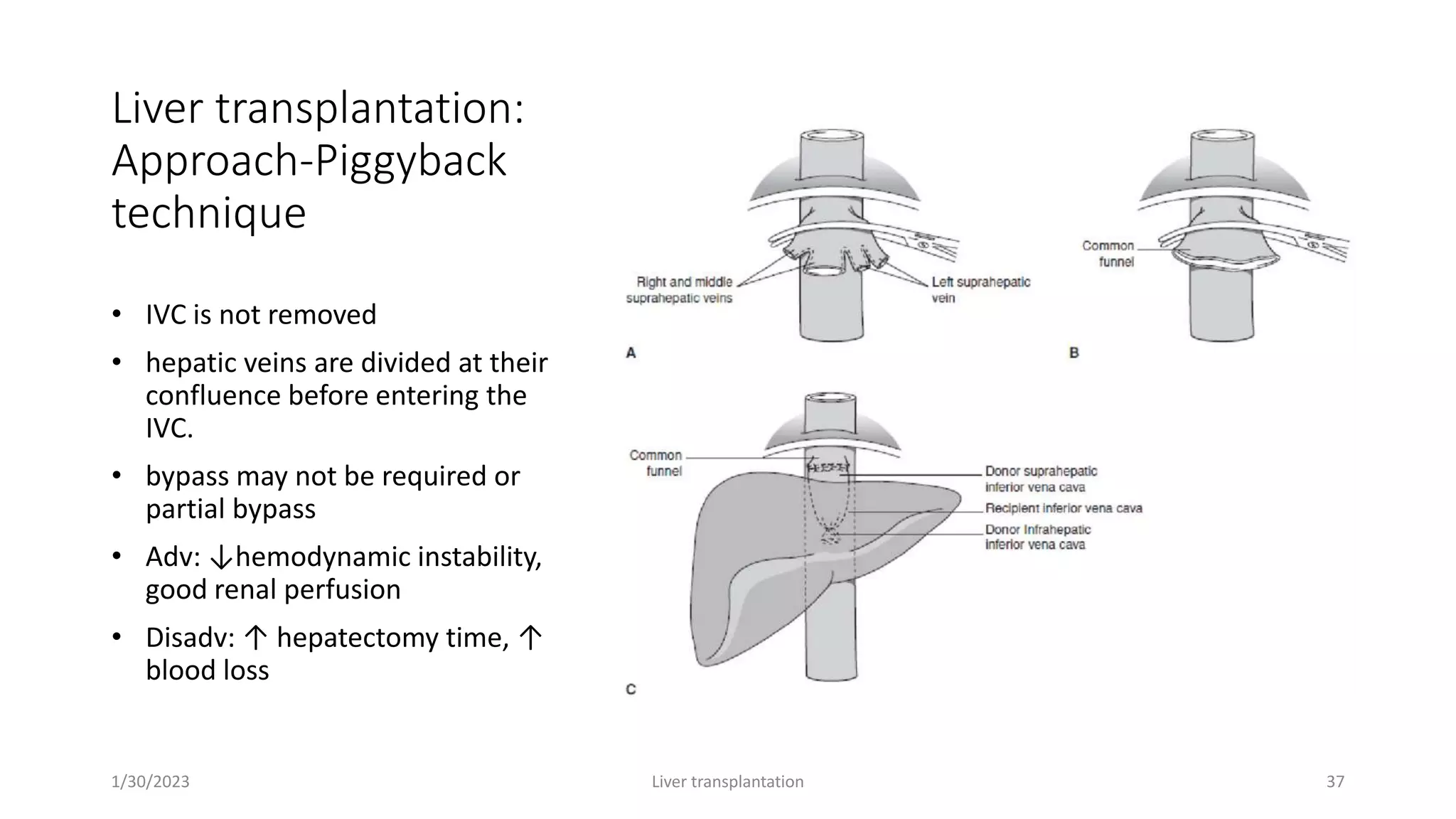 Principles of LIVER TRANSPLANTATION.pptx