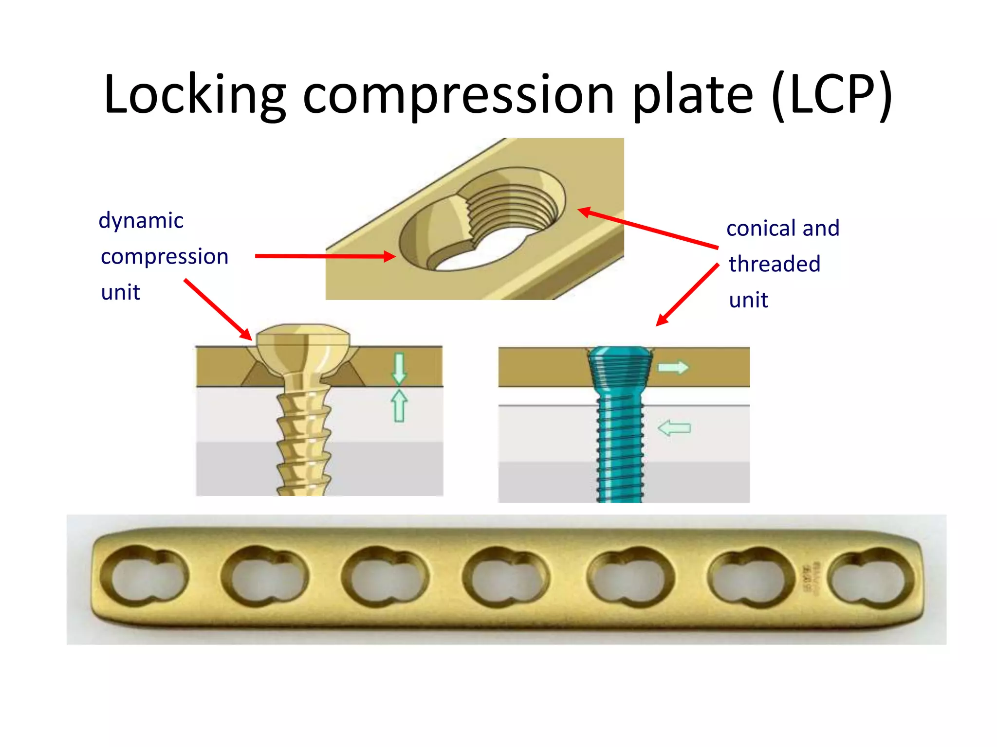 Principles of locking compression plates | PPTX