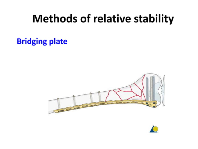Principles of locking compression plates | PPTX | First Aid | Injuries