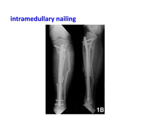 Principles of locking compression plates | PPTX