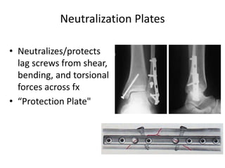 Principles of locking compression plates | PPTX