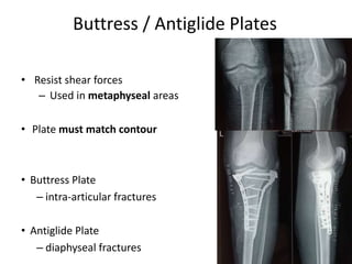 Principles of locking compression plates | PPTX