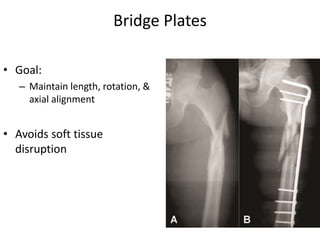 Principles of locking compression plates | PPTX