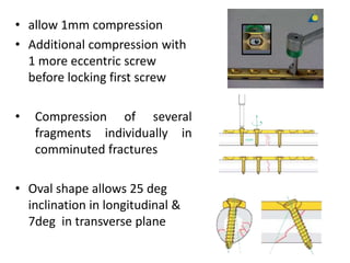Principles of locking compression plates | PPTX
