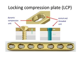 Principles of locking compression plates | PPTX