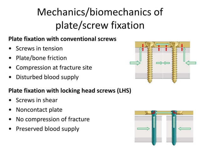 Principles of locking compression plates | PPTX | First Aid | Injuries