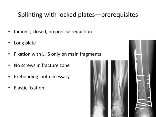 Principles of locking compression plates | PPTX | First Aid | Injuries