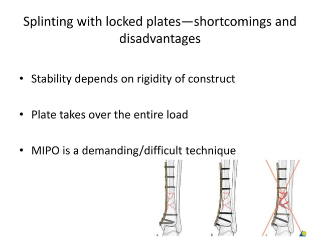 Principles of locking compression plates | PPTX | First Aid | Injuries