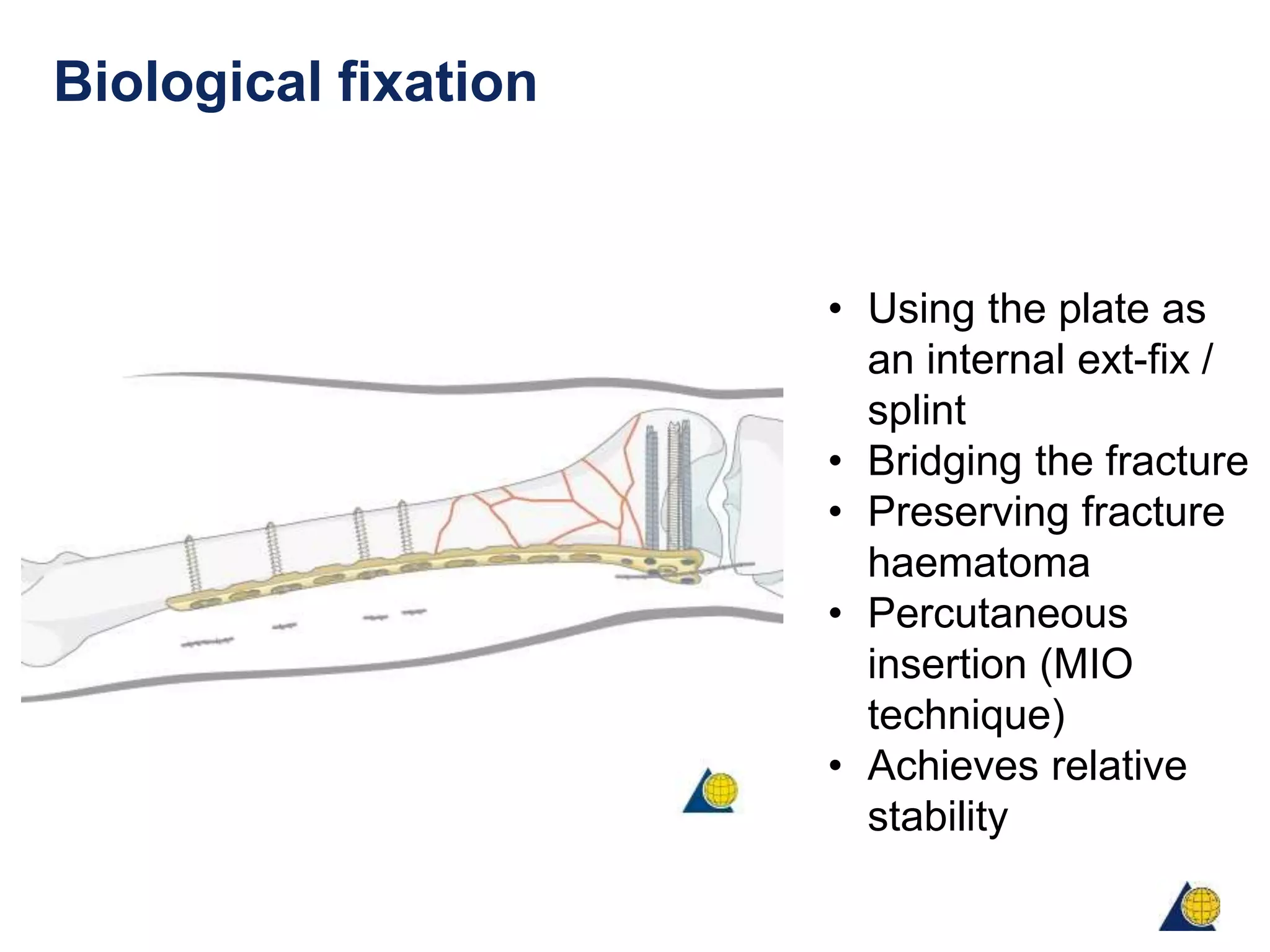 Principles of lock plate fixation AO | PPTX