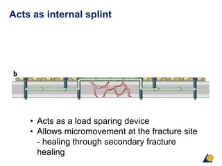 Principles of lock plate fixation AO | PPTX