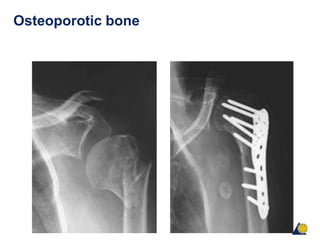 Principles of lock plate fixation AO | PPTX