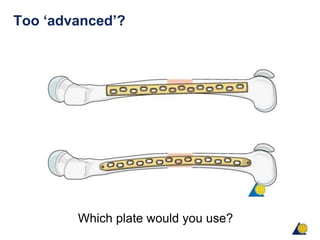 Principles of lock plate fixation AO | PPTX