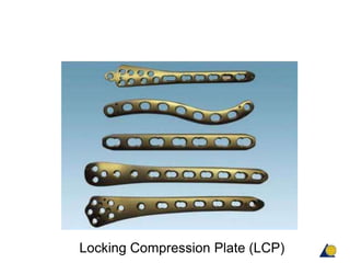 Principles of lock plate fixation AO | PPTX