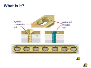 Principles of lock plate fixation AO | PPTX