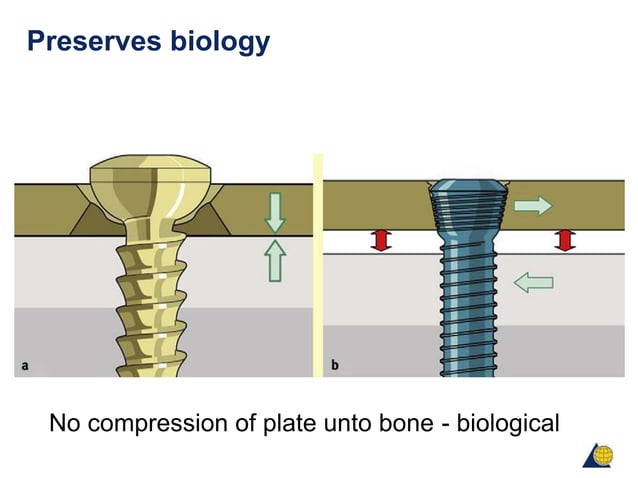 Principles of lock plate fixation AO