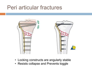 Principles of lock plates | PPTX