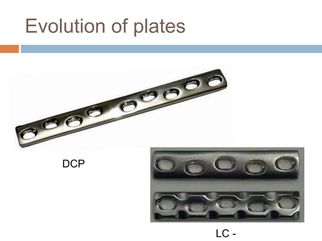 Principles of lock plates | PPTX | Bone and Joint Conditions | Diseases ...