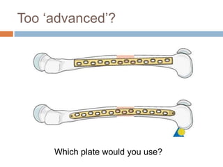 Principles of lock plates | PPTX