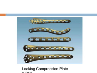 Principles of lock plates | PPTX
