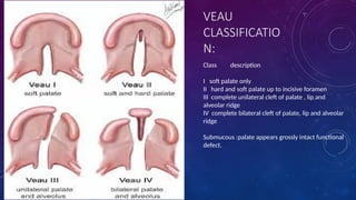 principles of management of cleft palate.pptx