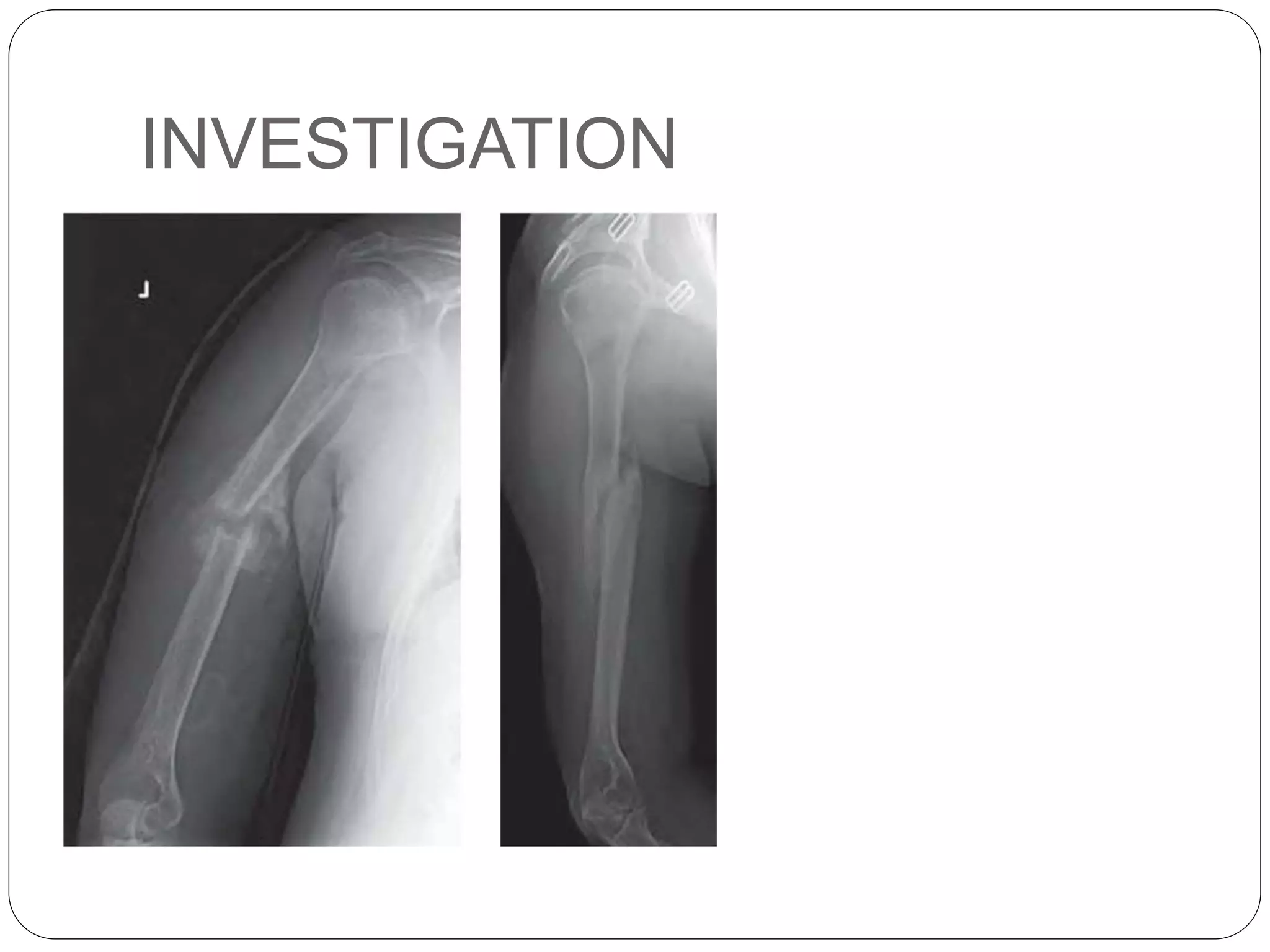 Principles of management of fracture non union | PPTX