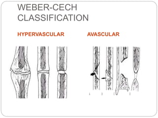 Principles of management of fracture non union | PPTX