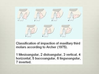 Principles of Management of Impacted Teeth Part I | PDF