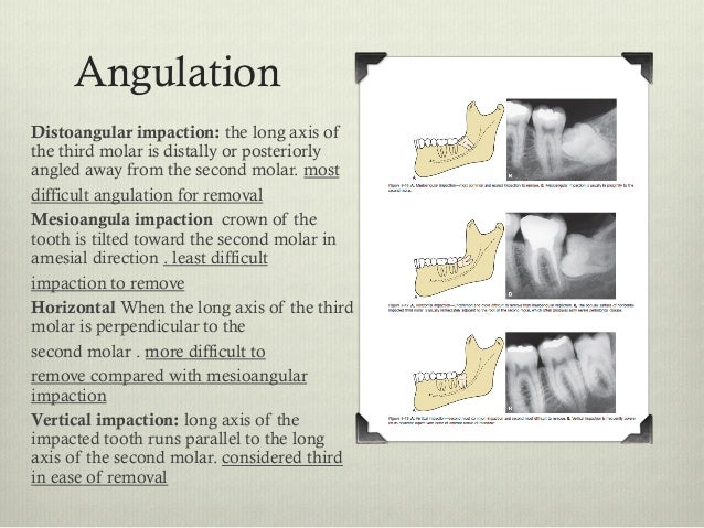 Principles of Management of Impacted Teeth Part I