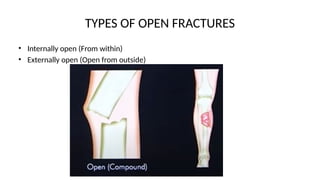 principlesofmanagementofopenfracture-200603225250-1.pptx