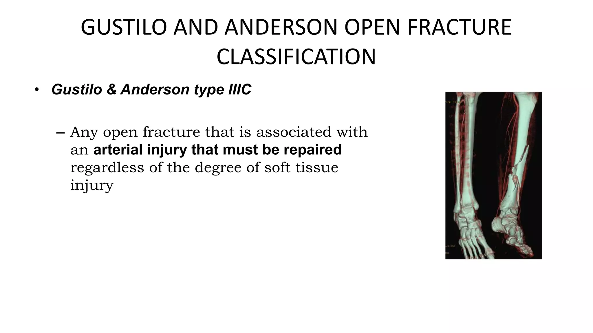 Principles of management of open fracture | PPTX