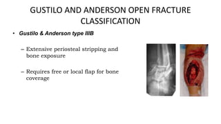 Principles of management of open fracture | PPTX