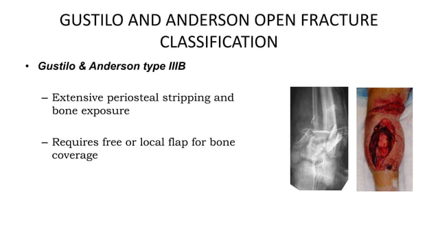 Principles of management of open fracture | PPTX | Death, Injury, or ...