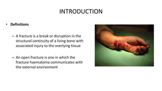 Principles of management of open fracture | PPTX