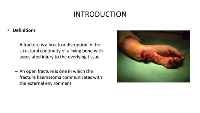 Principles of management of open fracture | PPTX | Death, Injury, or ...