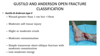 Principles of management of open fracture | PPTX | Death, Injury, or ...