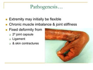 Principles of management of volkmann’s contracture | PPTX