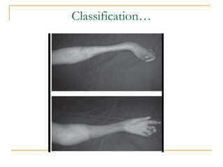 Principles of management of volkmann’s contracture | PPTX