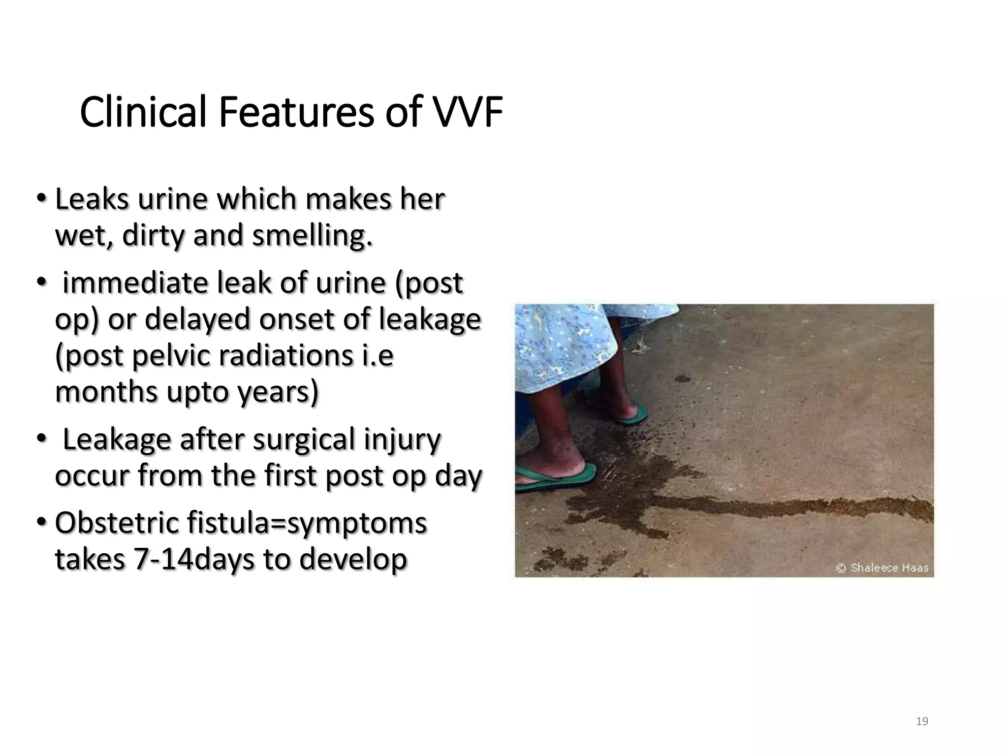 Principles of management of vvf | PPTX
