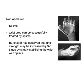 Peripheral Nerve Injury: Radial Nerve Palsy | PPTX