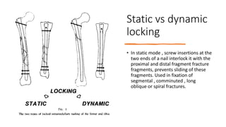 Principles of nailing by Dr Ritesh Jadav | PPTX
