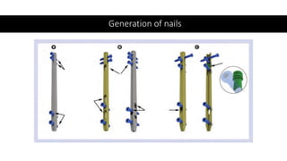 Principles of nailing by Dr Ritesh Jadav | PPTX