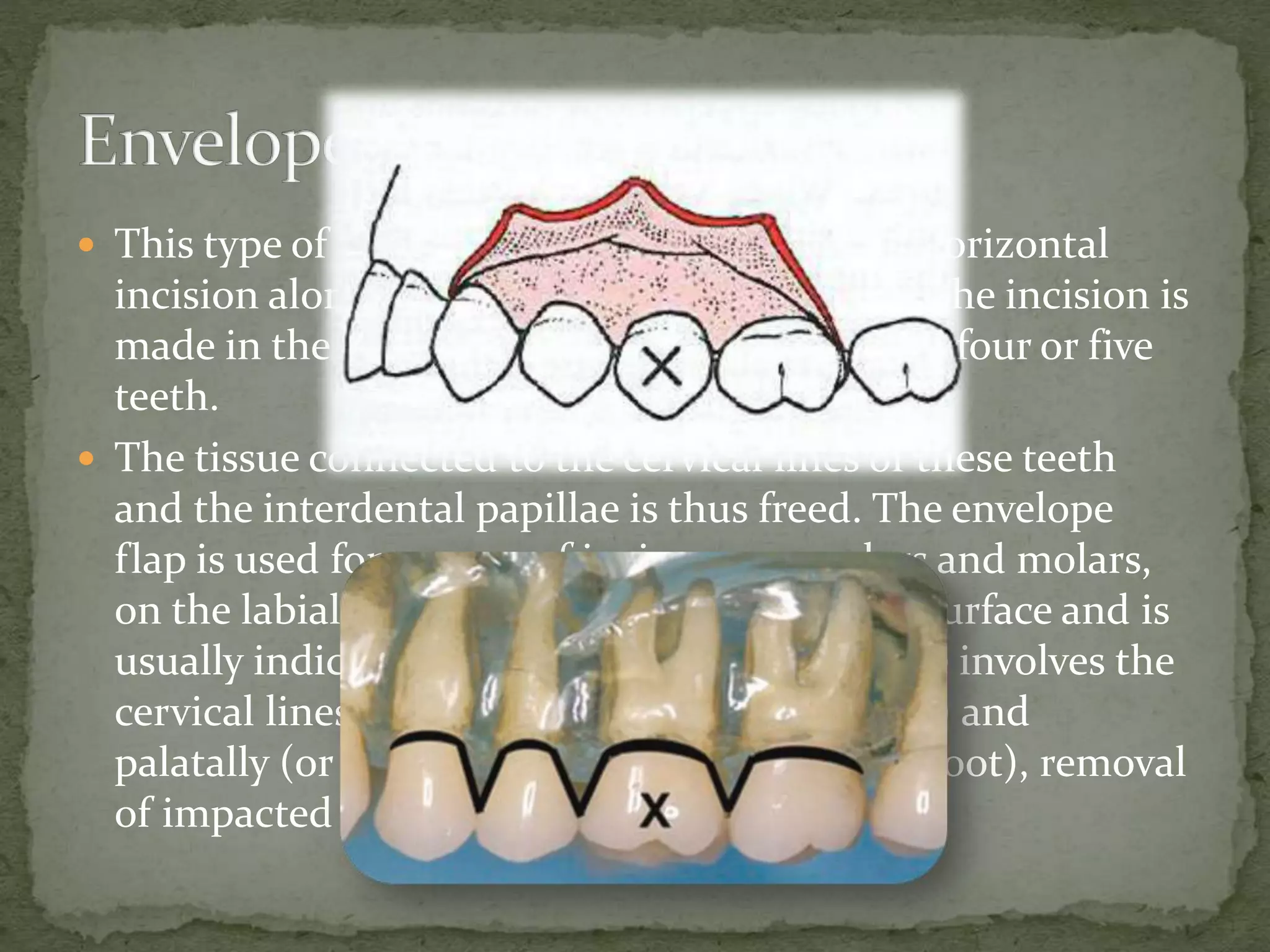 Principles of oral surgery | PPTX