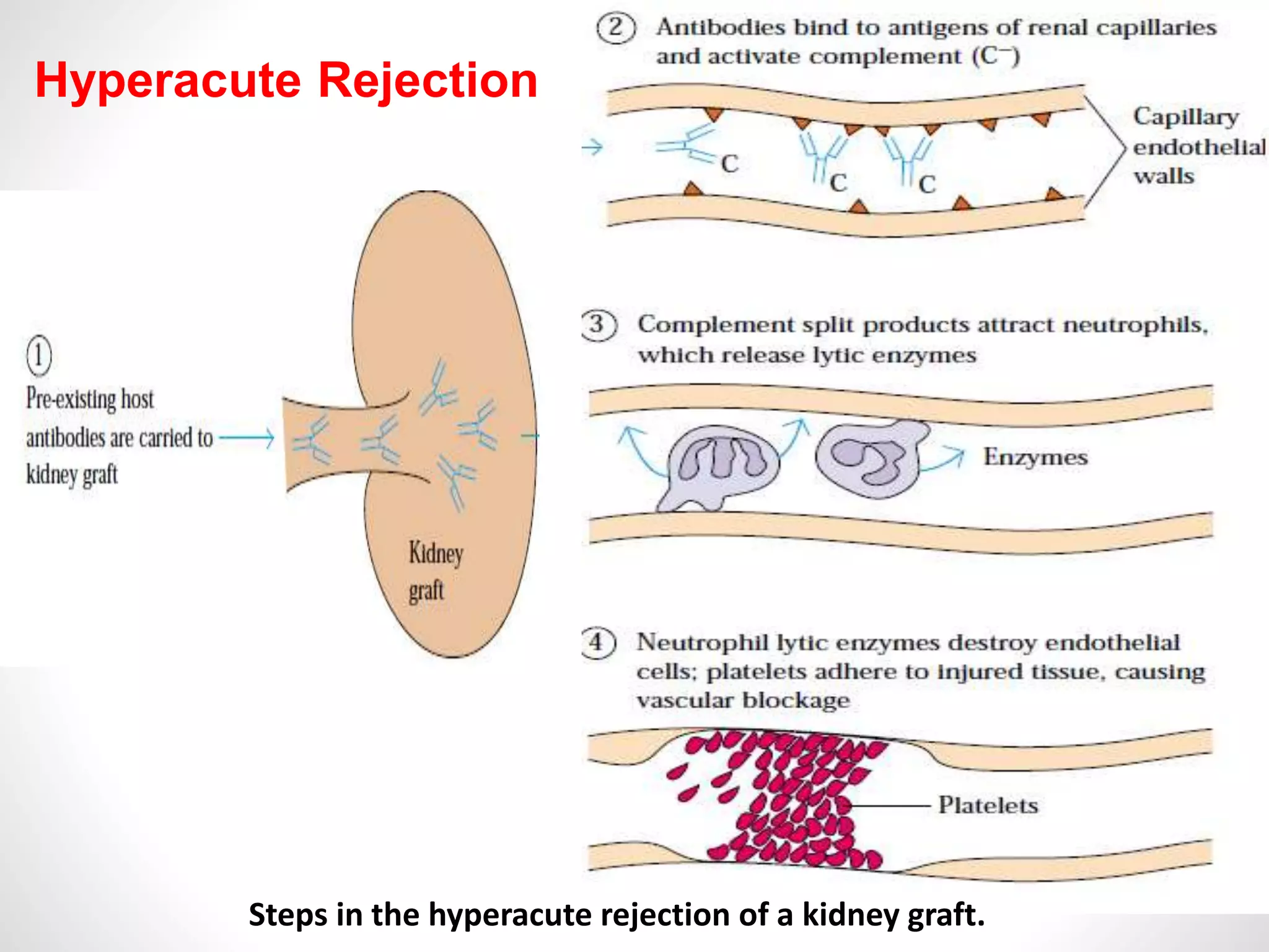 Principles of organ transplant and Renal transplant | PPTX