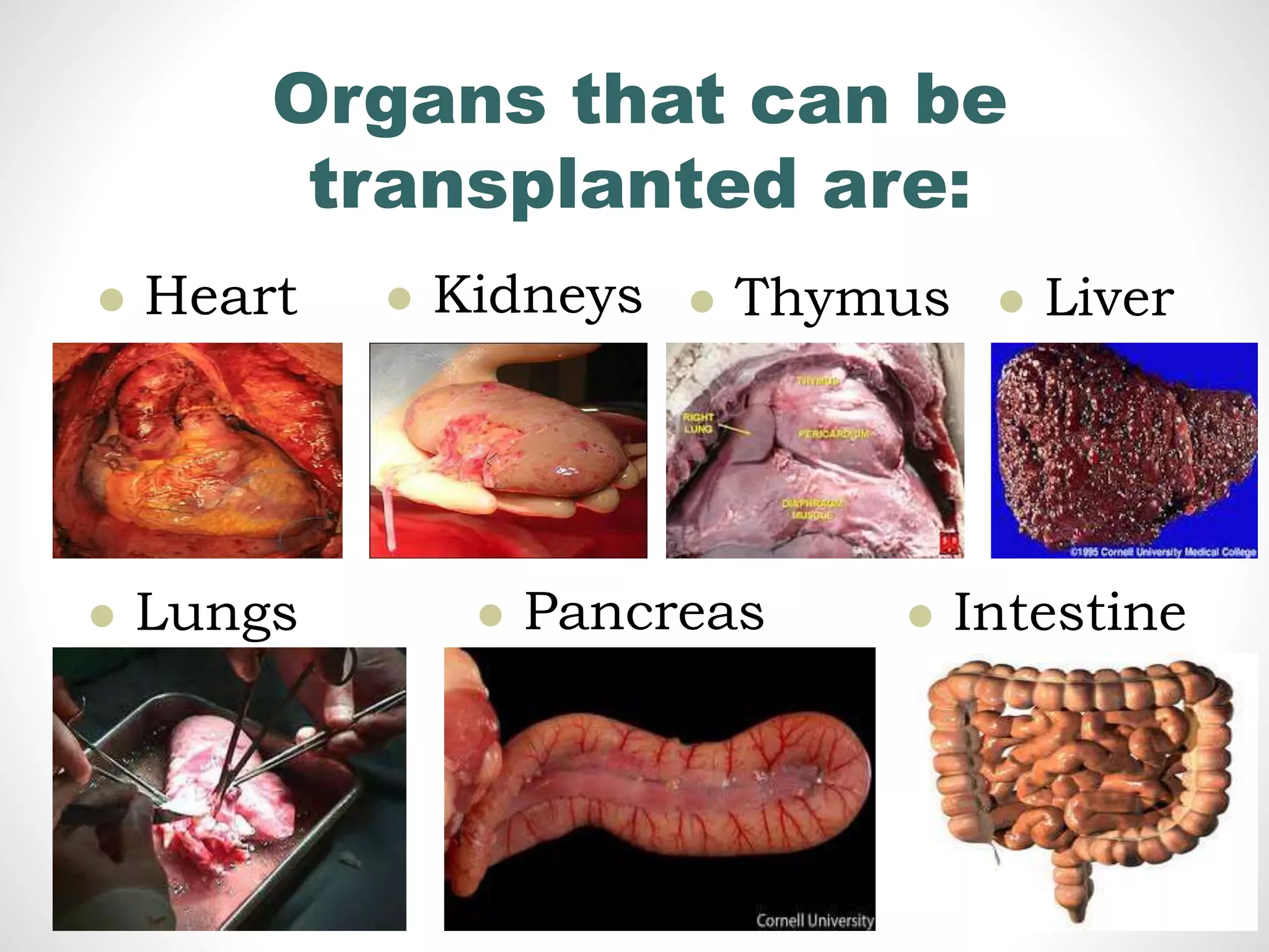 Principles of organ transplant and Renal transplant | PPTX