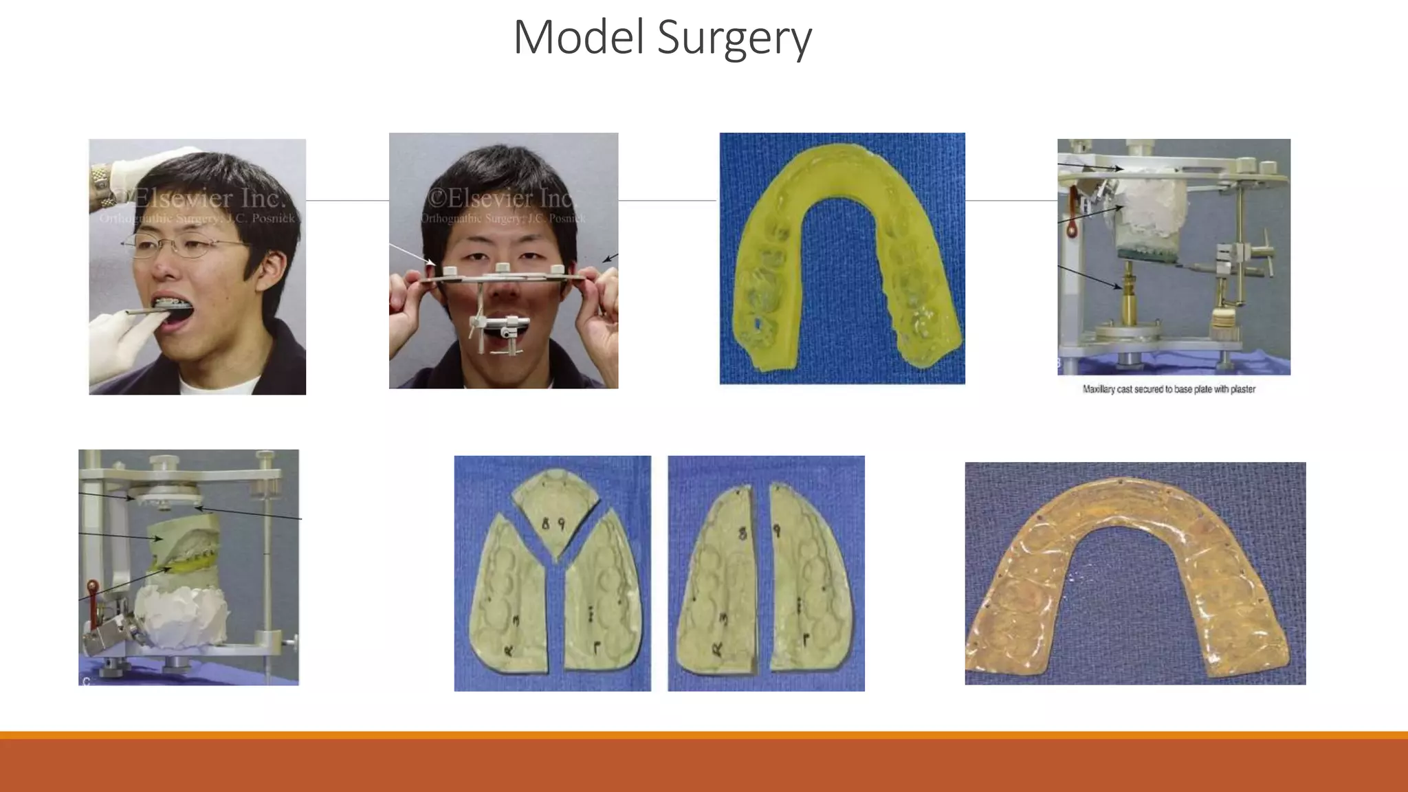 Principles of orthognathic management of dentofacial deformities | PPTX