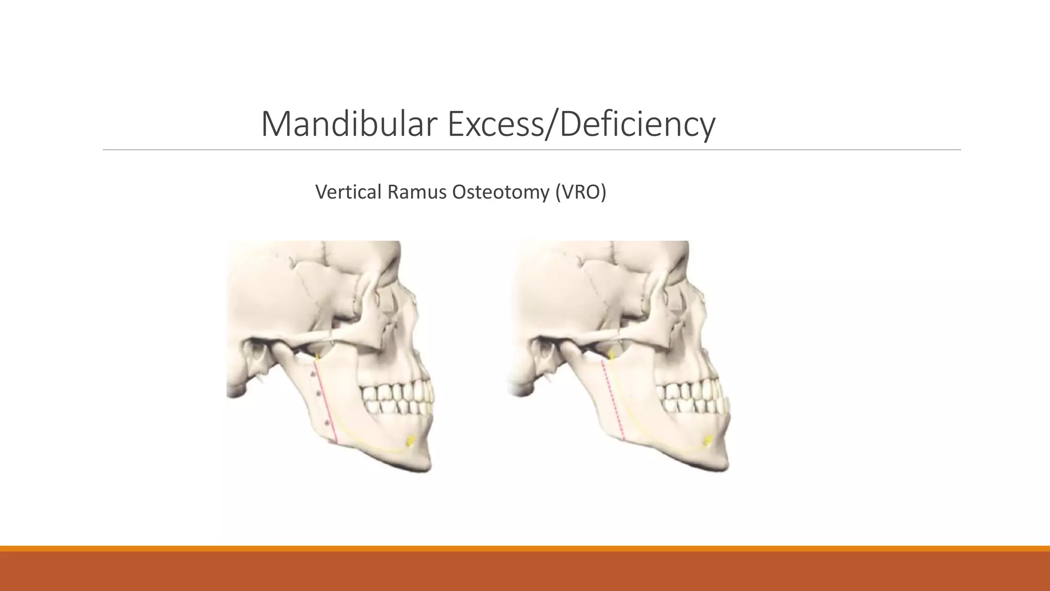 Principles of orthognathic management of dentofacial deformities | PPTX