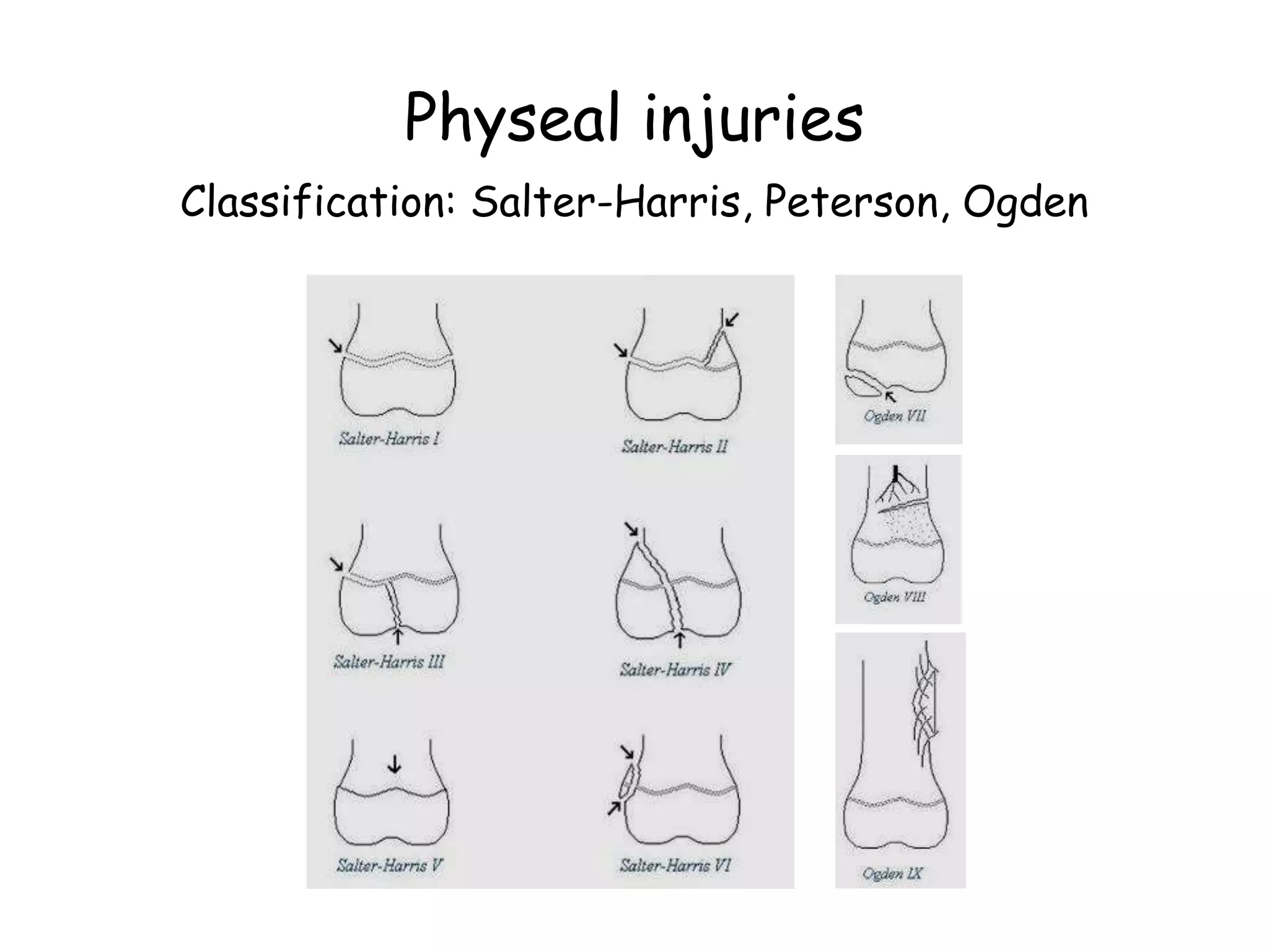 Principles_of_Pediatric_Fractures.ppt