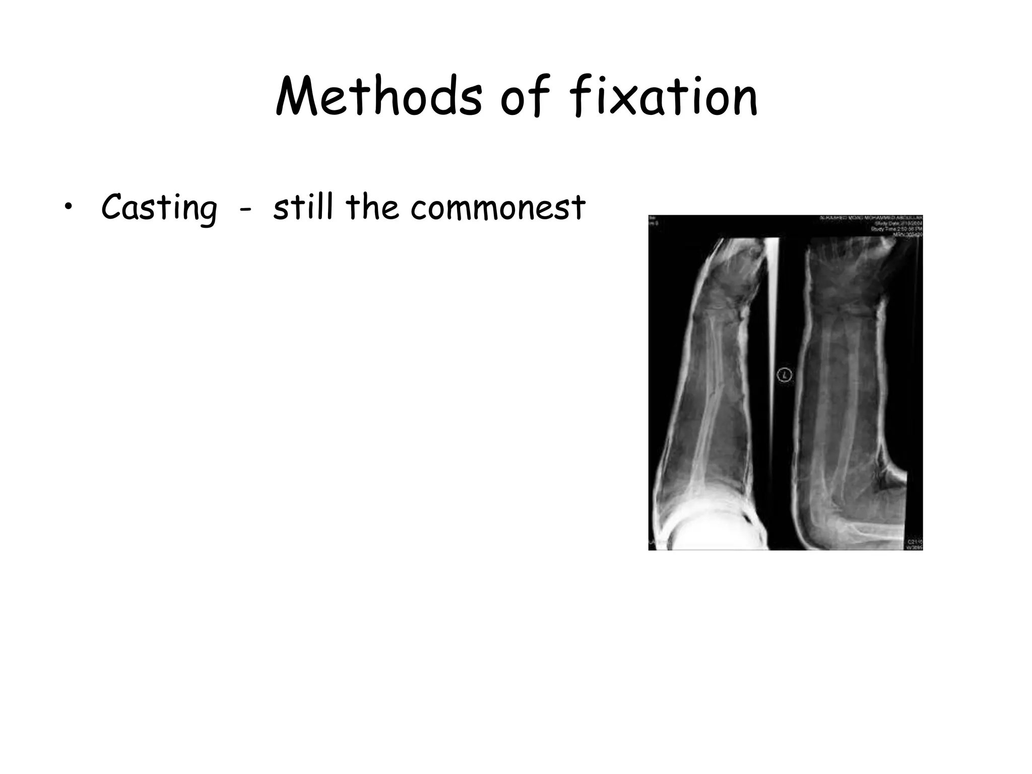 Principles_of_Pediatric_Fractures.ppt